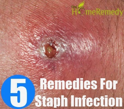 Herbal Remedies For Staph Infection ~ Mzizi Mkavu