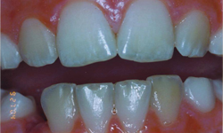 Celiac Brain: 55% of Kids with Celiac Disease have Dental Enamel ...