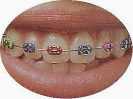 Martin Casale Ortodoncia Rápida e Invisible: Ortodoncia con brackets ...