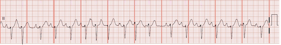 EKG Rhythm Strip Quiz 53: Atrial Rhythms