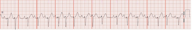 EKG Rhythm Strip Quiz 53: Atrial Rhythms
