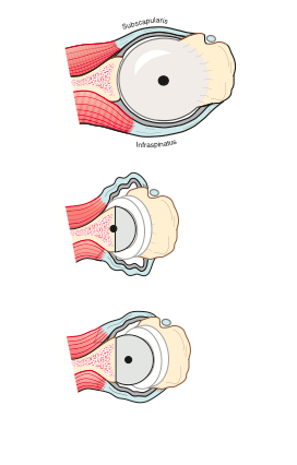 UW Shoulder and Elbow Academy: Reverse total shoulder - the clinical ...