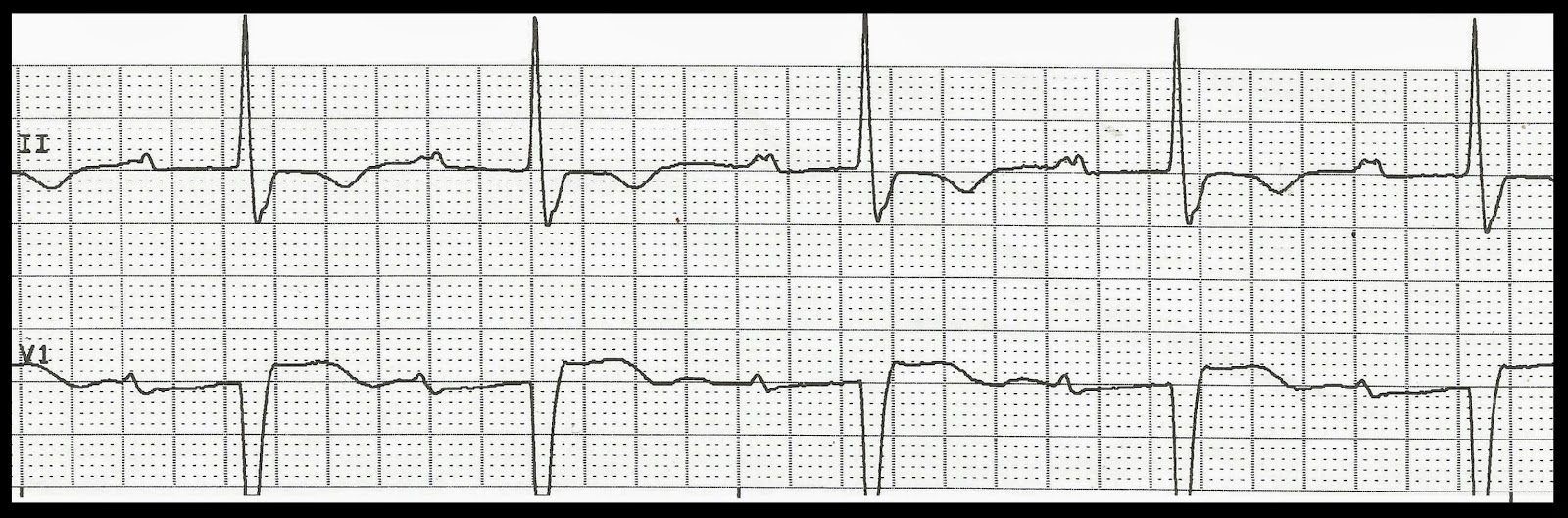 Various First Degree Heart Blocks