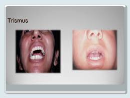Complicaciones de la anestesia local en odontologia