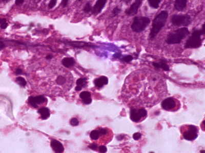 Amebiasis Intestinal: Amebiasis Intestinal