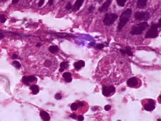 Amebiasis Intestinal: Amebiasis Intestinal