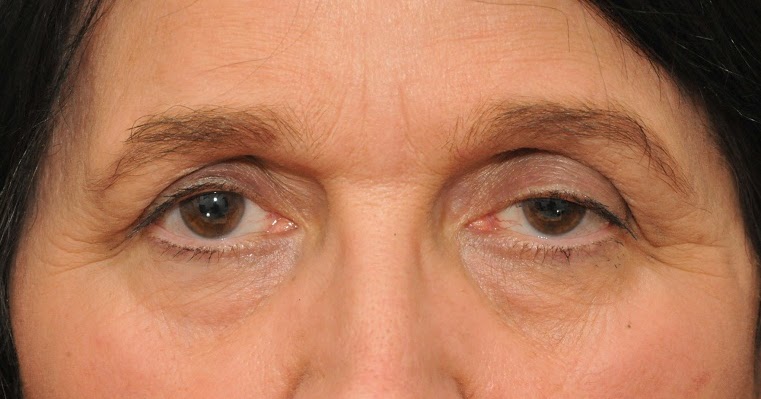 Droopy Eyelids – Causes and their Treatments | Eyelids Lift