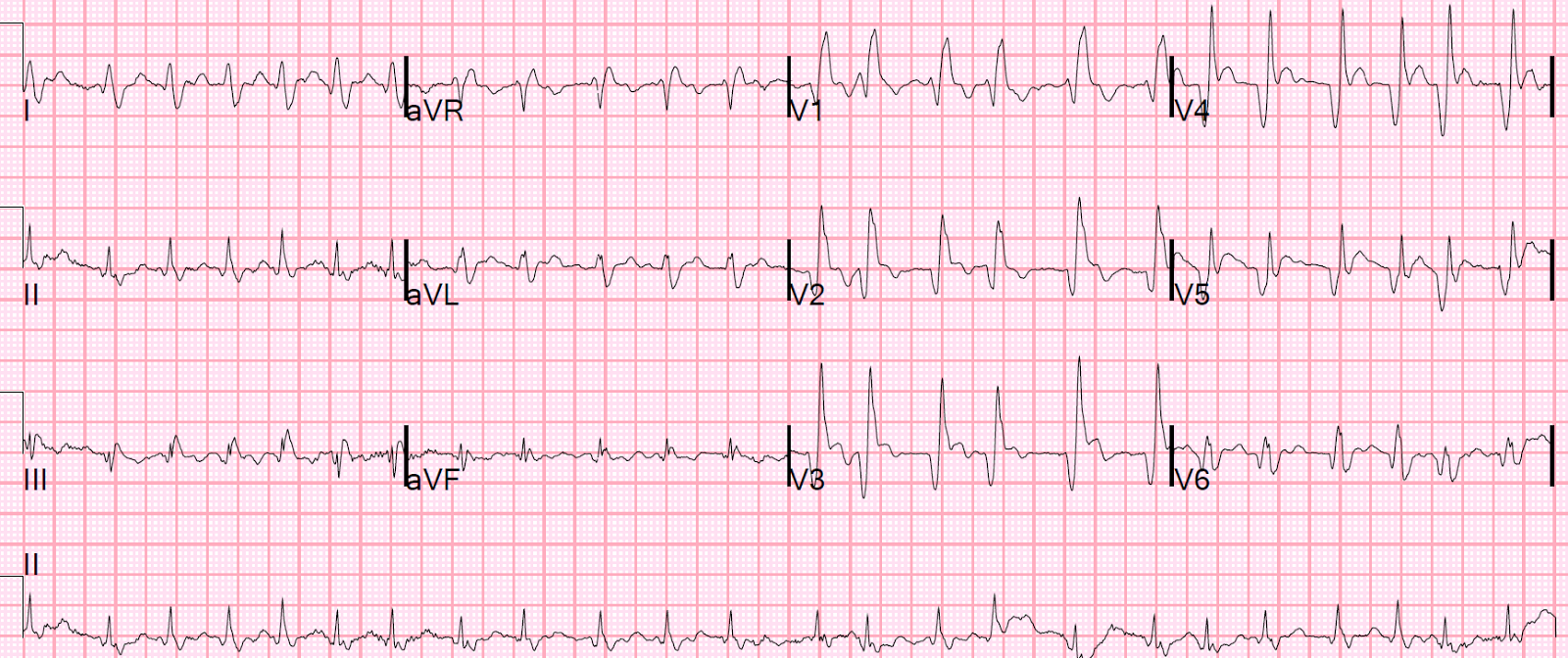 Dr. Smith's ECG Blog: June 2016