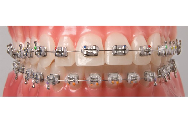 ¡LOS BRACKETS PUEDEN SER DIVERTIDOS! ORTODONCIA PARA TODOS: Brackets