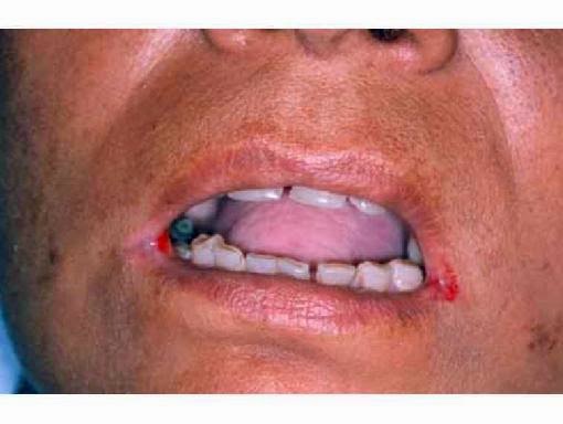 mynsgnotes.blogspot.com: Cheilosis