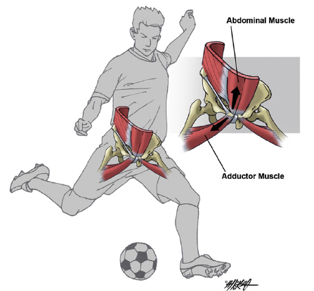 The MSK spot: Sports hernia and pelvic rehab