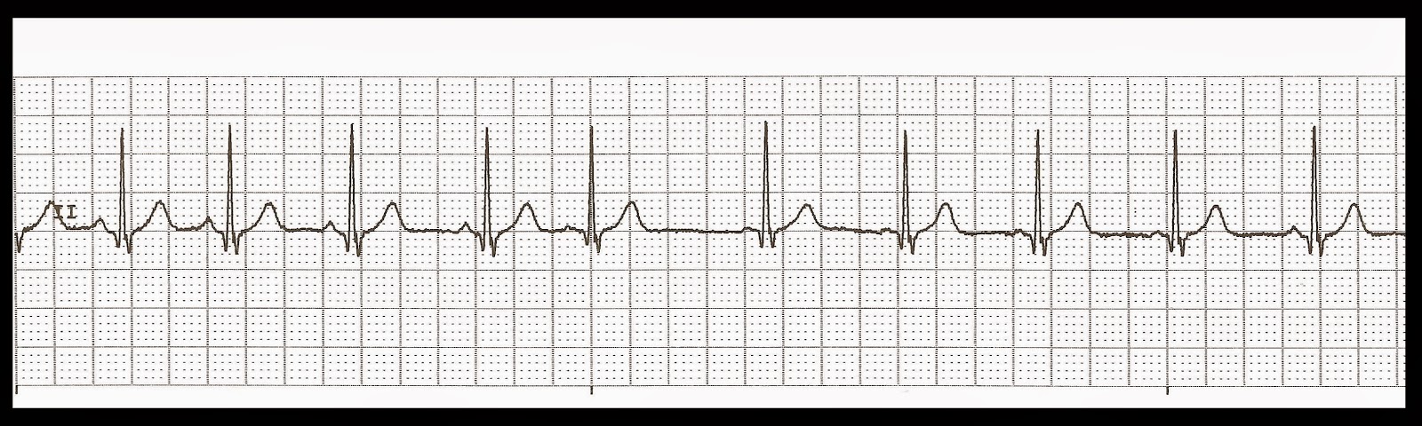 Practice EKG Strips 376