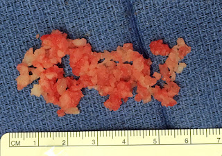 Surgery for Olliers Disease | Congenital Hand and Arm Differences ...