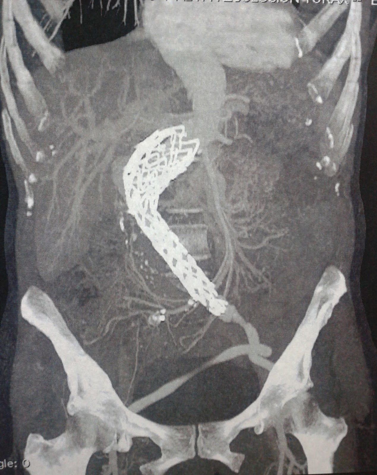 Vascular Mind : EVAR AORTO-UNILIAC (Hercules) AND FEMORAL-FEMORAL ...