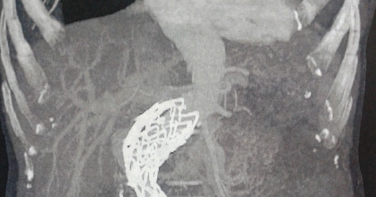 Vascular Mind : EVAR AORTO-UNILIAC (Hercules) AND FEMORAL-FEMORAL ...