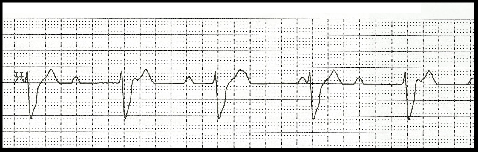 Basic ECG Rhythm Test 05