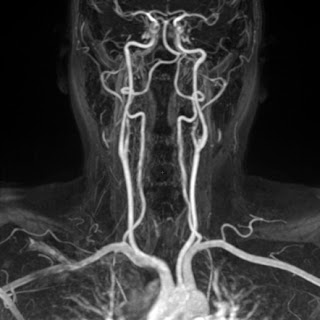 ABC Radiology Blog: Magnetic Resonance Angiography