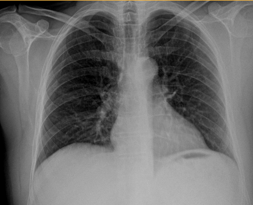 Wegener's Granulomatosis-Plain Film - Sumer's Radiology Blog