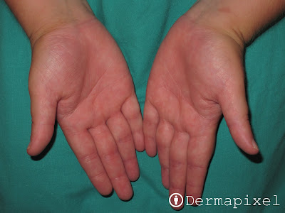 Dermapixel: diciembre 2011