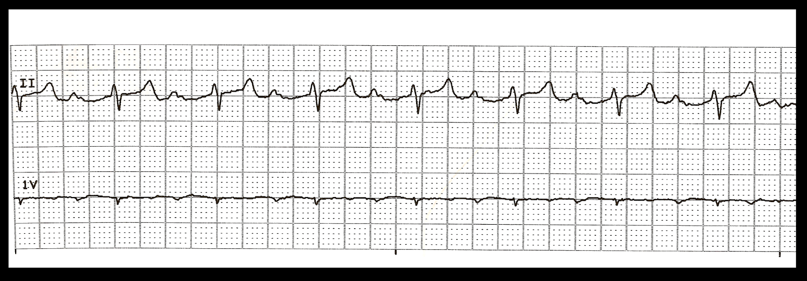 Various First Degree Heart Blocks