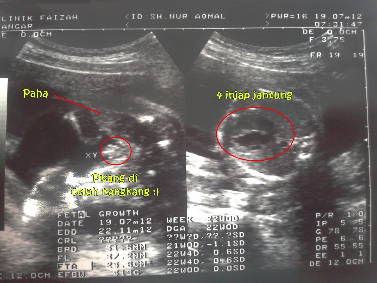 Scan Minggu Ke-22 (5 bulan) | Biar Sampai POLARIS