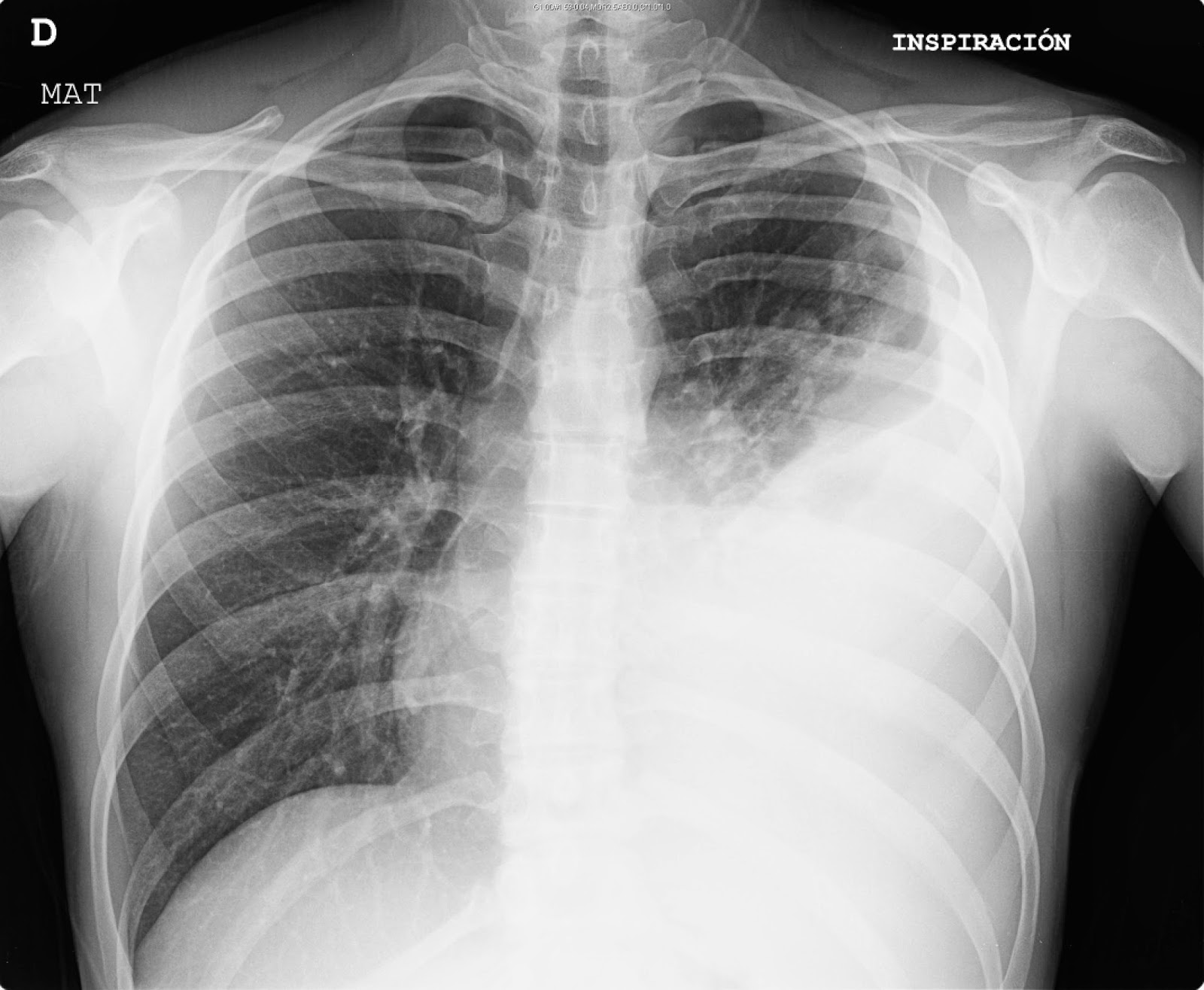 Trencadors docent: Evaluación del paciente adulto con tos crónica en ...