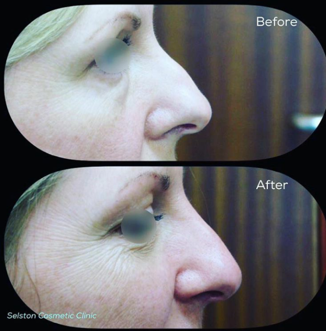 Selston Cosmetic Clinic: Correct Your Bumpy Uneven Nose with Dermal ...