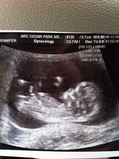 The Hunt's: Second Appointment 11 weeks 2 days