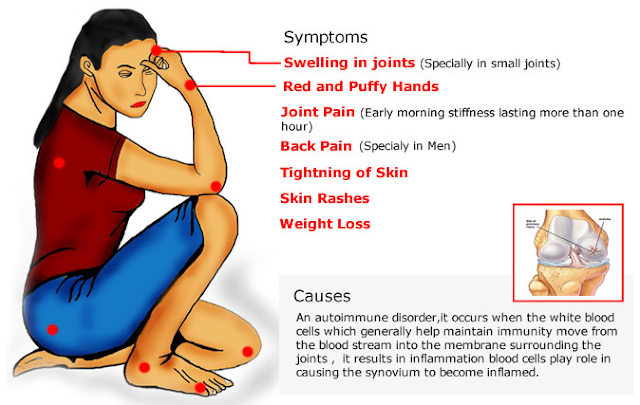 Gathiya Rog ke Kaaran or Lakshan | गठिया रोग के कारण और लक्षण | Cause ...