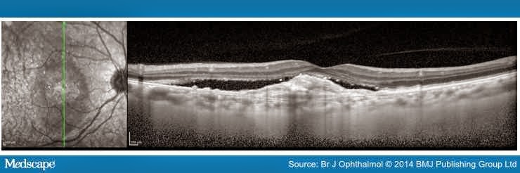 DEGENERACION MACULAR : DMAE humeda y la OCT