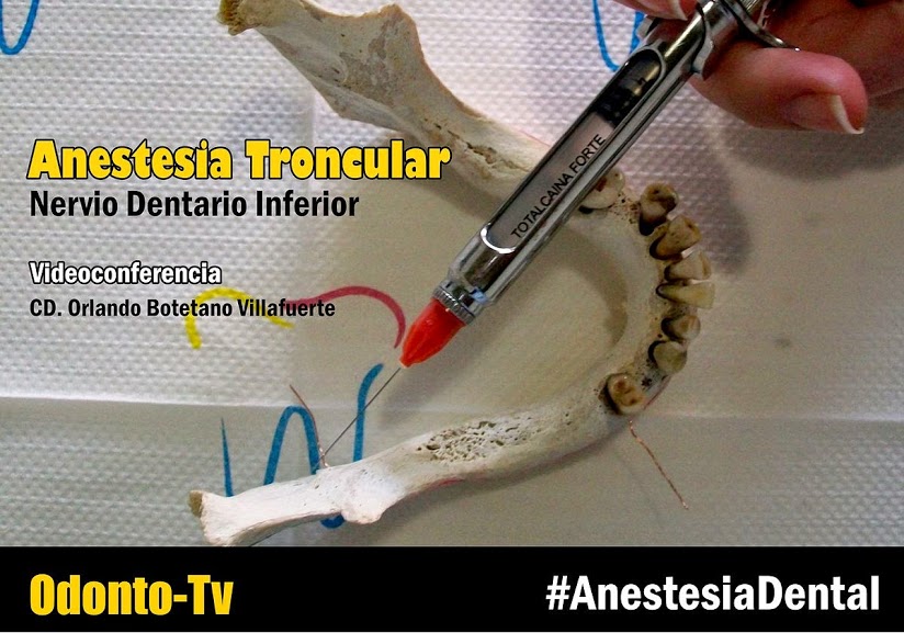 ANESTESIA TRONCULAR: Nervio Dentario Inferior - Videoconferencia del C ...