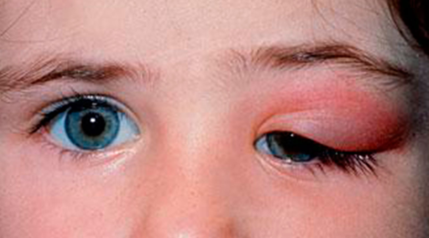 Exames Contrastados: Dacriocistografia