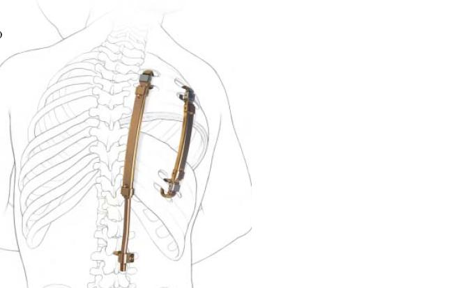 Fundación Respirar y Crecer con Escoliosis: El VEPTR