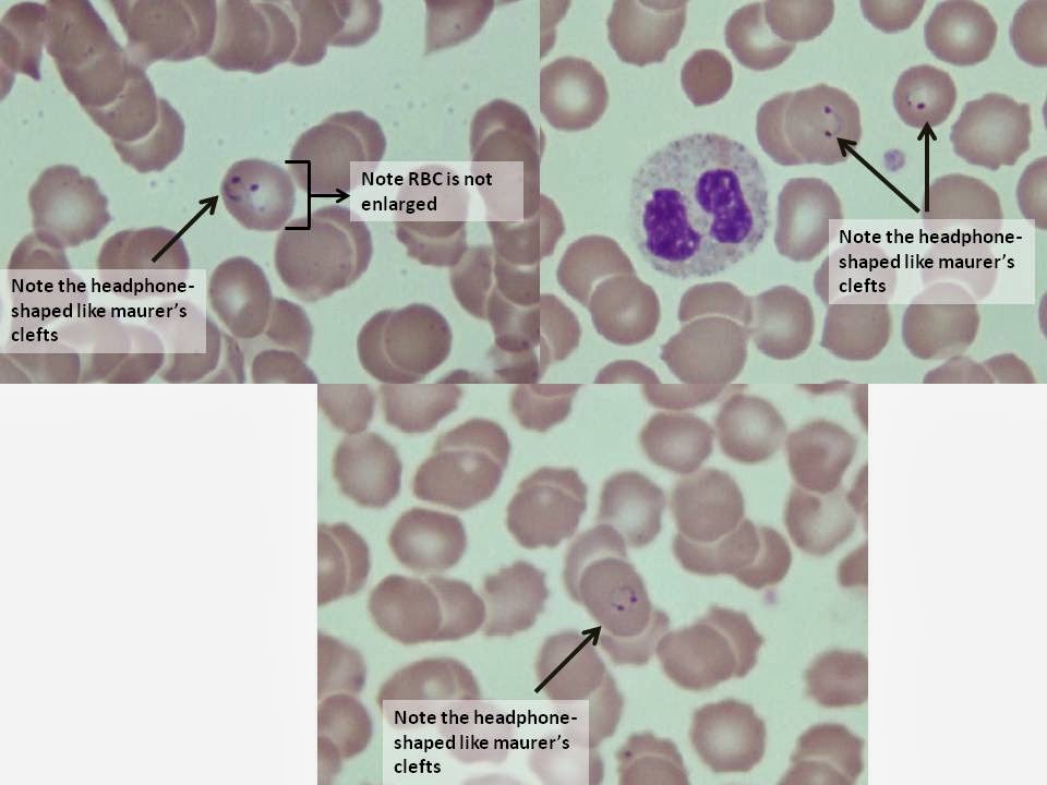Haematology in a NutShell: Plasmodium Falciparum in Thick and Thin Films