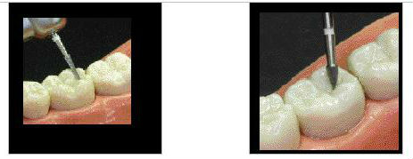 Resin komposit ~ Mine