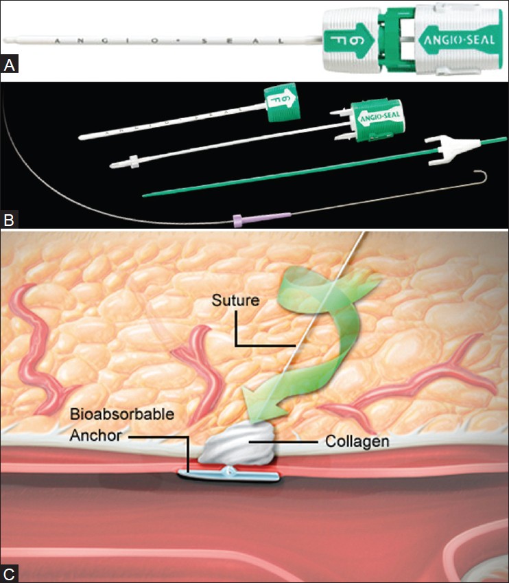 Vascular Mind : VASCULAR CLOSURE DEVICES