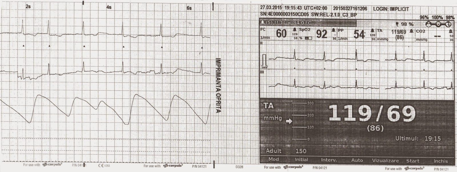 Infarct miocardic acut, bradicardie, soc cardiogen si accident vascular ...