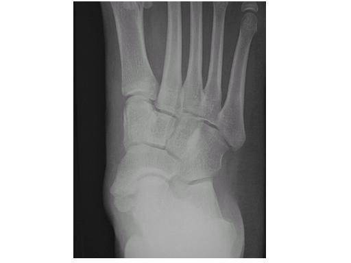 Lesdoup: Accessory Navicular