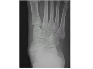 Lesdoup: Accessory Navicular