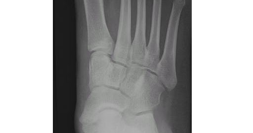 Lesdoup: Accessory Navicular