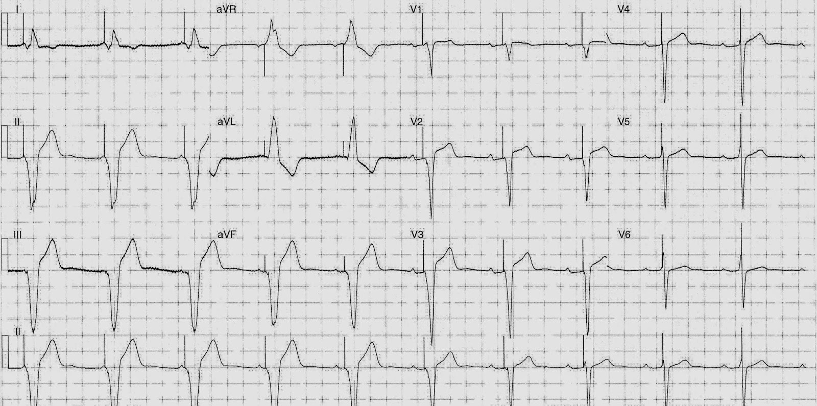 ECG of the Week: ECG of the Week - 3rd March 2014 - Interpretation