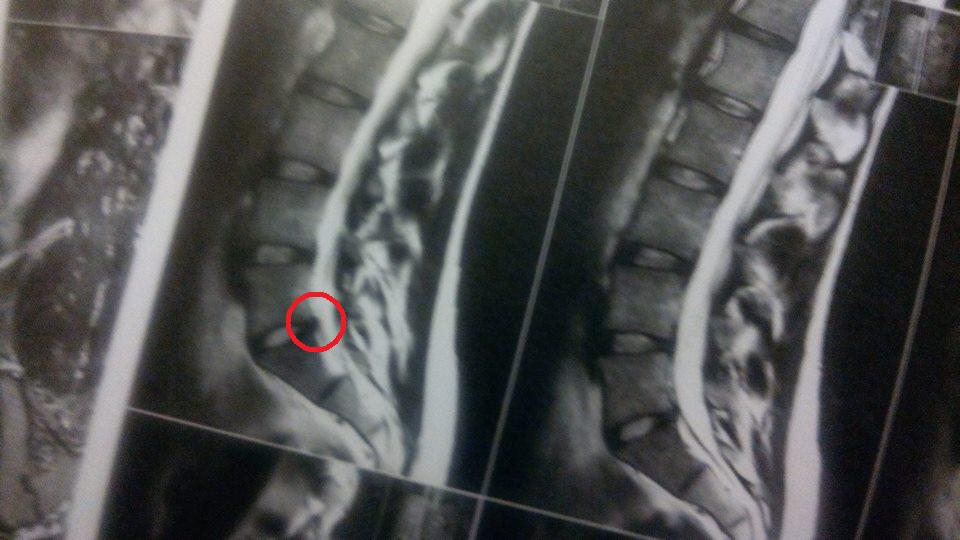 Montañas de Camille: Diagnóstico: Protusión Discal.