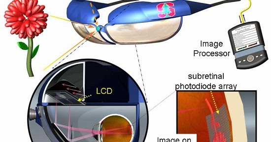 Tecnología del Futuro: Chip en la retina: ojos biónicos para devolver ...