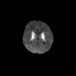IRRADIATED - Radiology: Maple Syrup Urine Disease (MSUD)