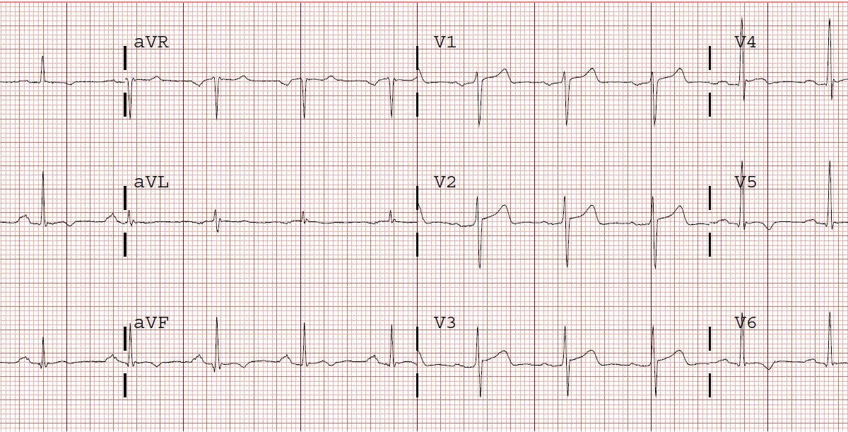 Dr. Smith's ECG Blog: Benign T-wave Inversion: view video or read text