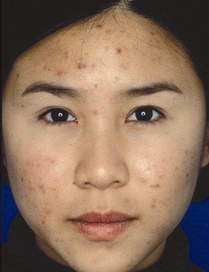 What Are Blemishes, And How Can You Get Rid Of Them?, 40% OFF