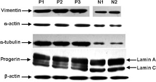 RESEARCH ON PROGERIA