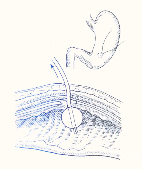 OTMANAGE: GASTROSTOMY PROCEDURE 4