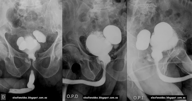 El esfenoides: Divertículos vesicales. 2 imágenes 1 caso.