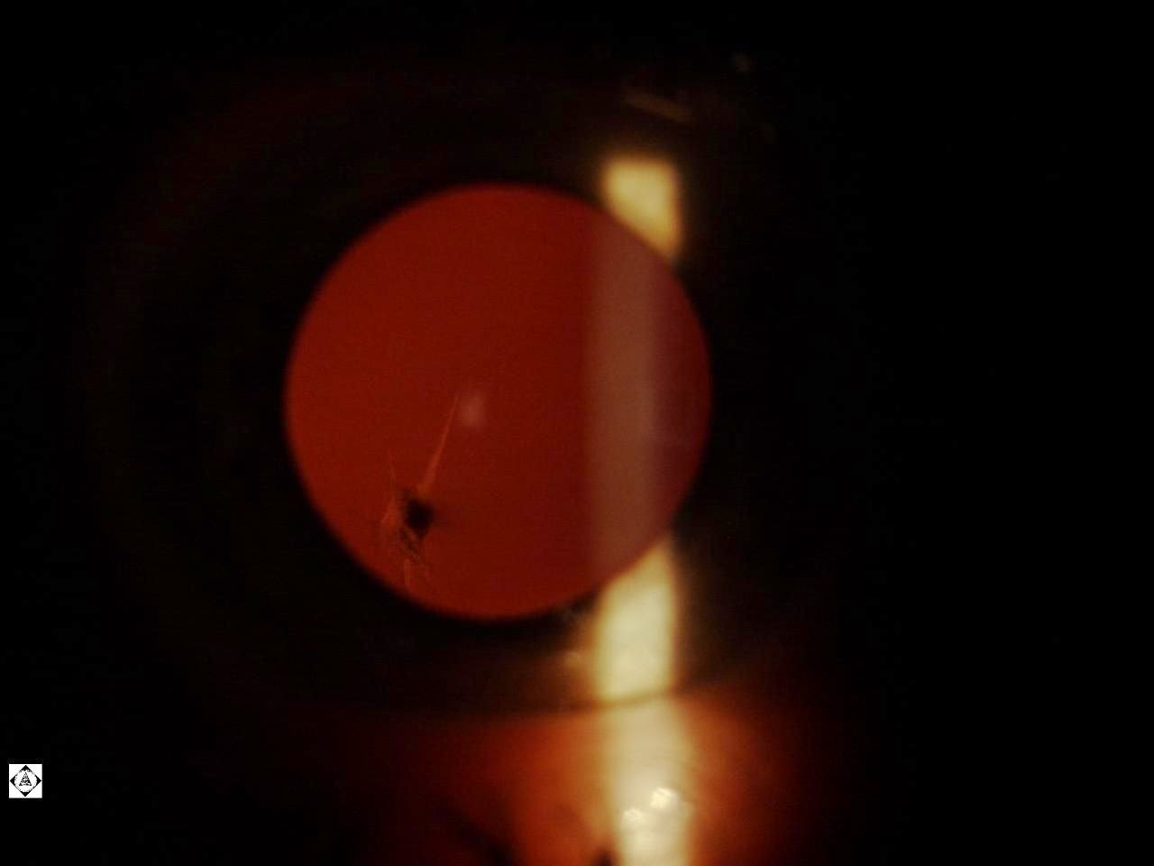 Sonoran Desert Eye Center Persistent Hyaloid Artery